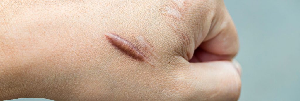 Keloid Scar Removal in Clarksville, TN - Treatment For Keloids